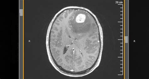 Glioblastoma Cells Imitate Immature Neurons To Invade The Brain The Scientist Magazine®