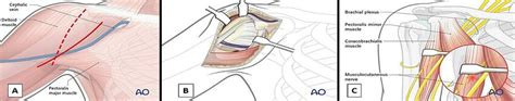A And B The Deltopectoral Approach Utilizes The Deltoid And Pectoralis Download Scientific