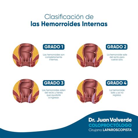 👨🏻‍⚕las Coloproctólogo En Lima Dr Juan Valverde Facebook