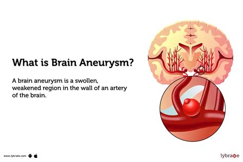 Brain Aneurysm Causes Symptoms Treatment And Cost