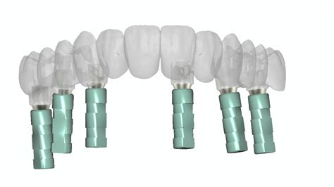 Occlusion Reconstruction Of Upper Jaw Using Digital Implants And Restorations
