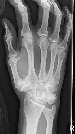 Lunate Dislocation Radiology Case Radiopaedia Org