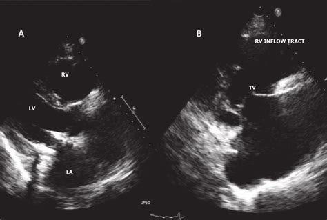 A Parasternal Long Axis Two Dimensional Echocardiographic View