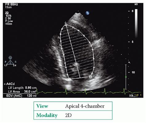 Lv Mass Measurement Echo