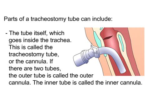 Tracheostomy Tube Parts
