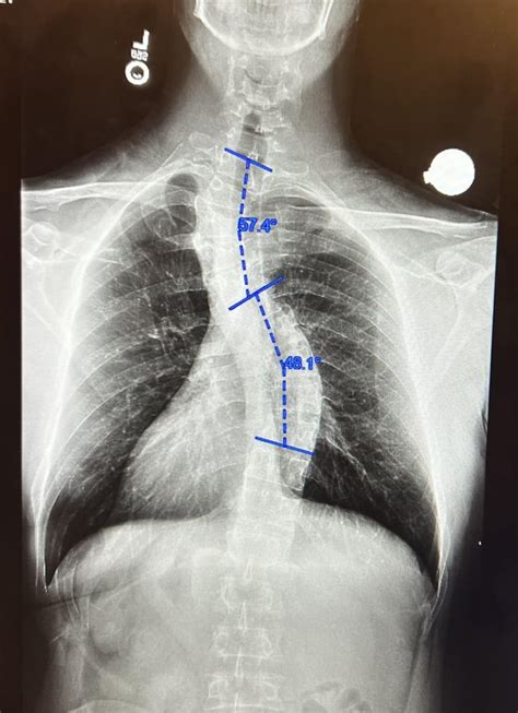 What Causes Pain In Scoliosis Rscoliosis