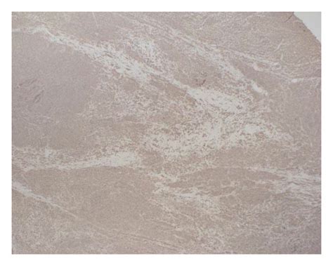 A There Were Areas With High Cellularity And Bizarre Nuclei B Download Scientific Diagram