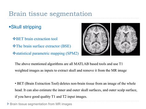 Brain Tissue Segmentation From Mr Images Ppt