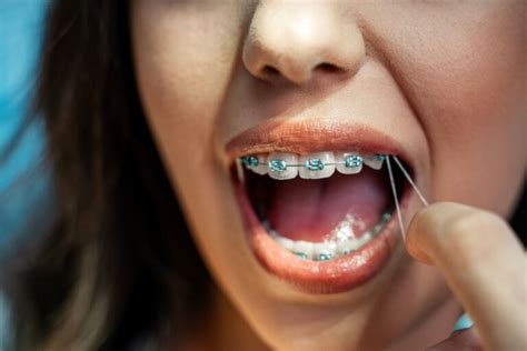 Why Do I Need To Wear Rubber Bands On My Braces Serenity