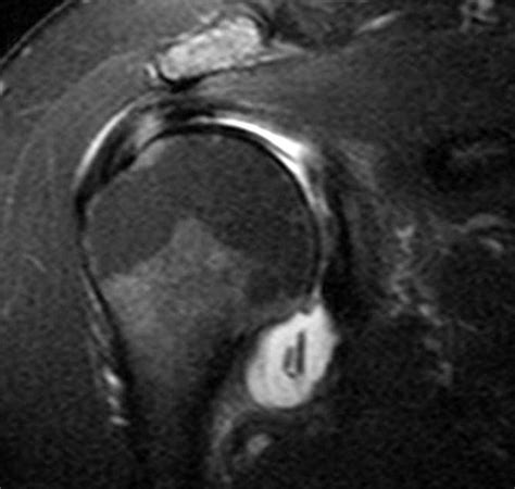 Chondrolysis Of The Glenohumeral Joint Radsource