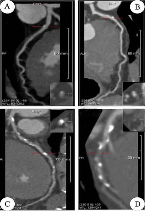 The Percentage Of Left Anterior Descending Coronary Artery Lad