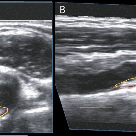 Carotid Plaque Images Obtained With 3d Us The 3d Image Is Viewed With Download Scientific