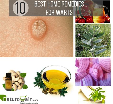 Water Warts Home Treatment At Annabelle Toomey Blog