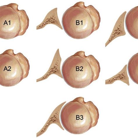 Walch Classification Of Glenoid Morphology In Primary Glenohumeral Download Scientific Diagram