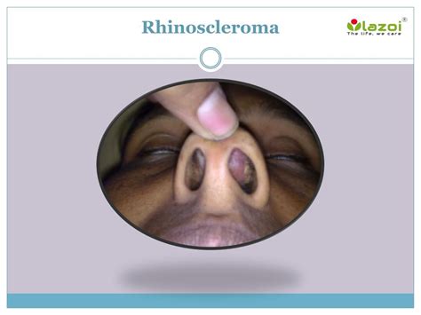 Ppt Rhinoscleroma Causes Symptoms Daignosis Prevention And