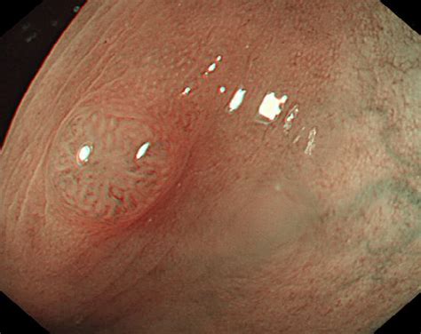 Wasp Classification Optical Diagnosis Of Polyps Endoscopy Campus