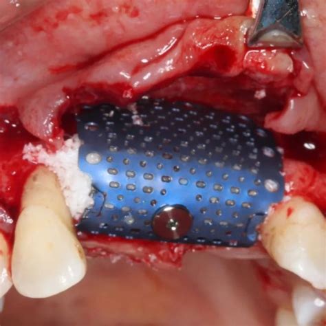 Titanium Mesh Membrane