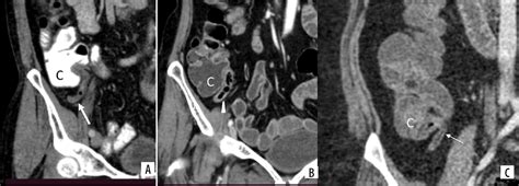 Computed Tomography Evaluation Of Variations In Positions And Measurements Of Appendix In