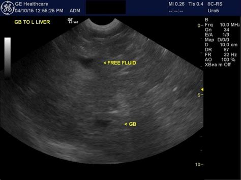 Abnormal Gallbladder Liver And Abdominal Effusion Members Forum