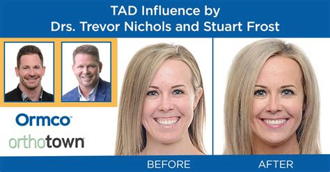 Ormco On Linkedin One Of The Most Common Uses For Tads In Our Practice Is To Correct Gummy