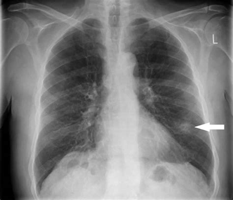 Solitary Pulmonary Nodule Definition Causes Symptoms Diagnosis Treatment