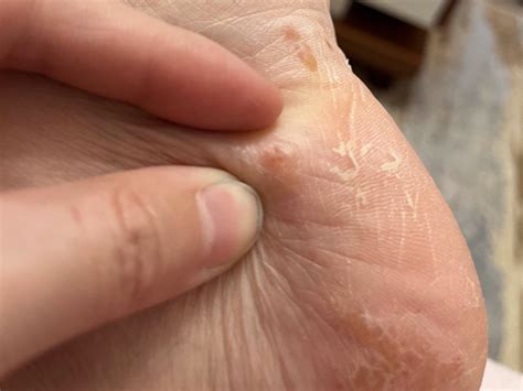 발바닥 껍질 벗겨짐 습진 연고보다 원인 박멸 네이버 블로그