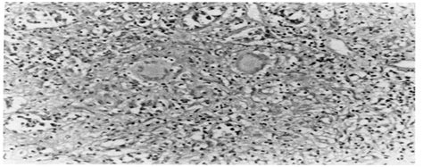 Granulomatous Hypophysitis And Bilateral Optic Neuropathy Journal Of Neuro Ophthalmology