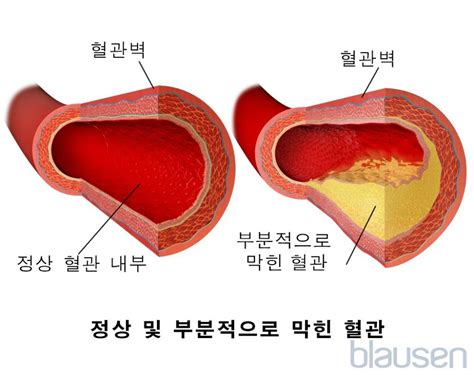 Image 정상 혈관 및 부분적으로 막힌 혈관 Msd 매뉴얼 일반인용