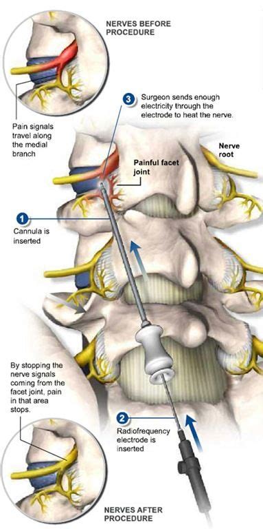 Facet Joint Nerve Block Injection Mapasgmaes