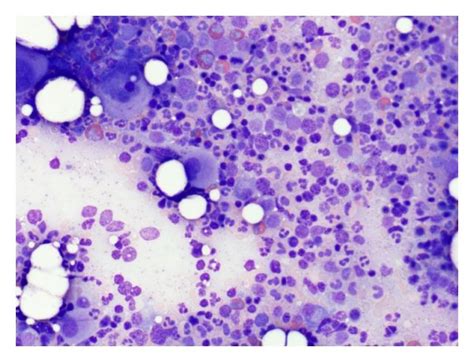 Bone Marrow Aspirate Showing A Hypercellular Marrow With Trilineage Download Scientific Diagram