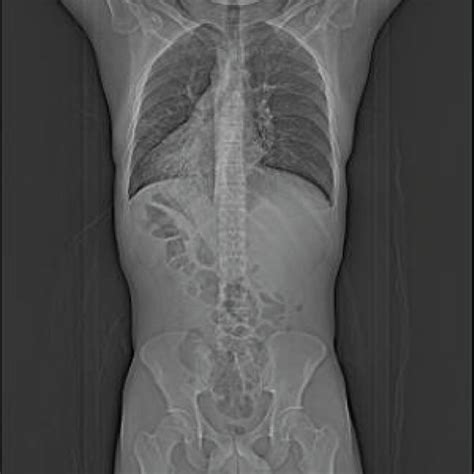 Multiplanar Reconstruction In Computed Tomography Scan Highlighting The