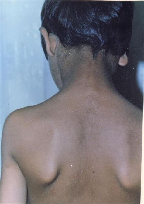 Polymorphic Discrete And Coalescent Maculopapular Lesions And Plaques