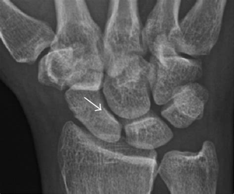 Scaphoid Wrist Fracture Denver Colorado — Dr Nick Golinvaux