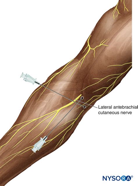 Cutaneous Blocks For The Upper Extremity Landmarks And Nerve