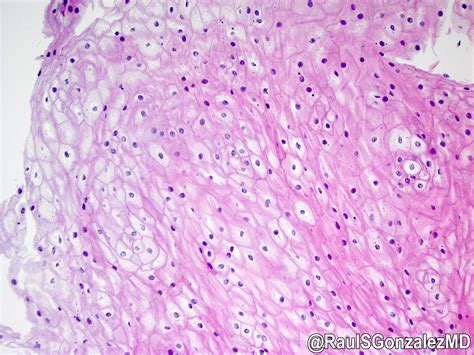 Acanthosis Histology