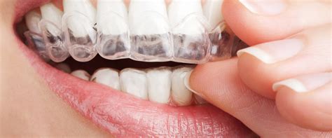 Can Invisalign Retainers Be Adjusted