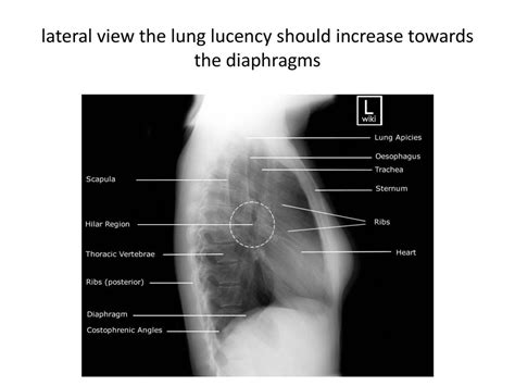 What Is Lung Field Lucency At Mark Bevill Blog