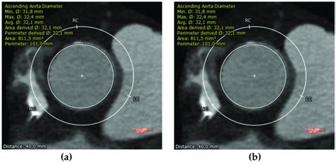 A Sinotubular Junction And B Proximal Ascending Aorta Evaluated By