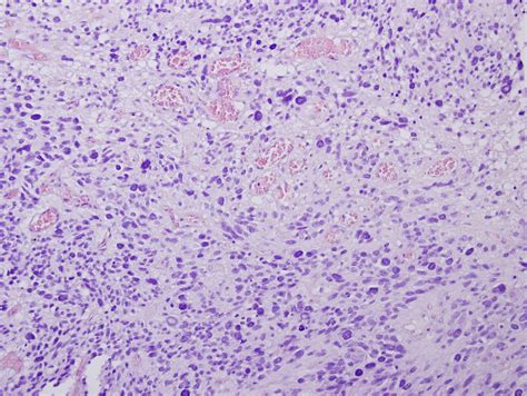 Pathology Outlines Anaplastic Ependymoma