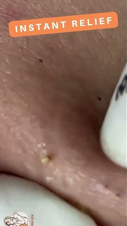 Cystic Acne Extractions Whiteheads New 🤩😮 Youtube