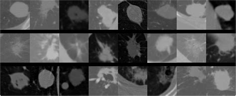 Frontiers Accurate Classification Of Lung Nodules On Ct Images Using