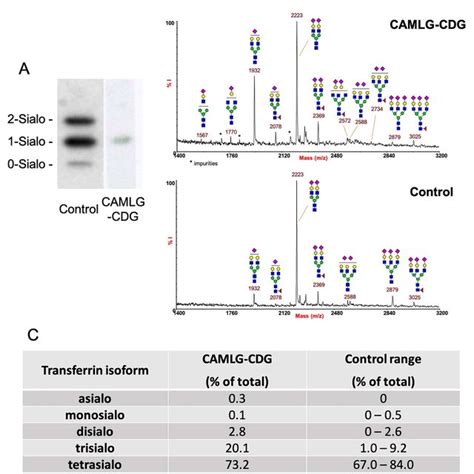 Serum Glycosylation Abnormalities Show Combined Type Ii N Linked And