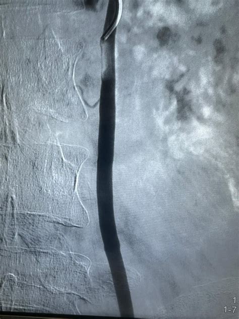 Varicocele Embolization Interventionalradiology Minimallyinvasive Menhealth Fertility