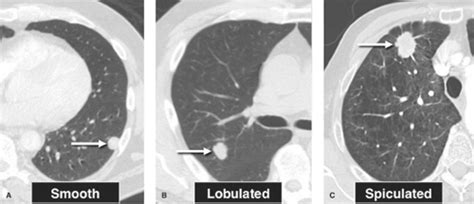 Solitary Pulmonary Nodule Lung Nodule Size Chart What The Size Of