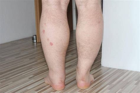 Enthesitis Causes Risk Factors Symptoms Diagnosis And Treatment