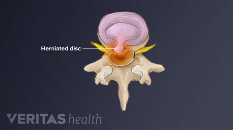 Diagnosing A Lumbar Herniated Disc Spine Health