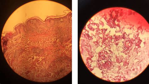 Superficial Lymphocytic Infiltrate And Small Vessel Vasculitis In The