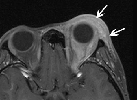 Orbital Pseudotumor When Orbital Disease Is Mistaken For Neurologic