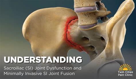 Understanding Si Joint Dysfunction And Minimally Invasive Fusion
