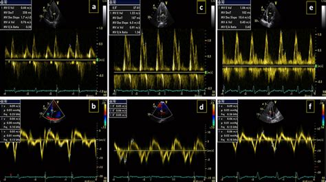 Grading Of Diastolic Dysfunction A B Grade 1 C D Grade 2 E F Grade 3 Download Scientific